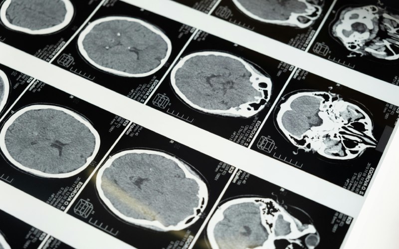 The 3 Most Prevalent Symptoms of a Brain Parasite Attack – Biglaps.com